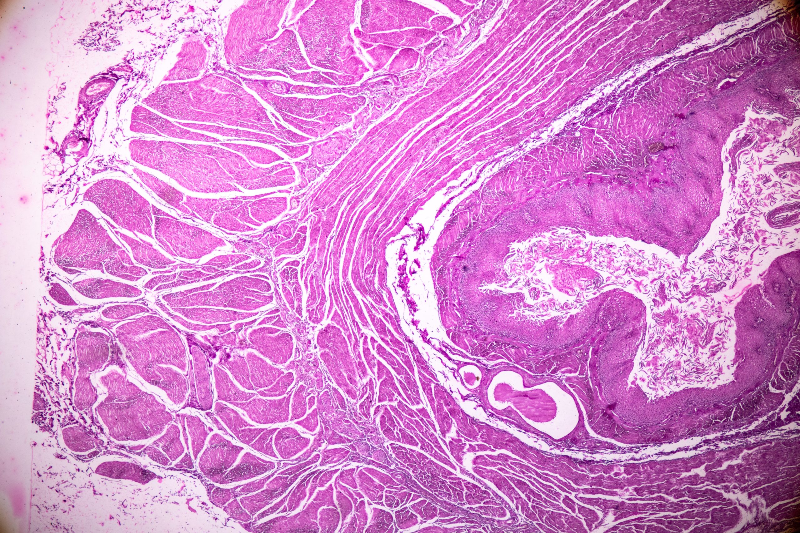 Expert Care for Chiari Malformation in Los Angeles