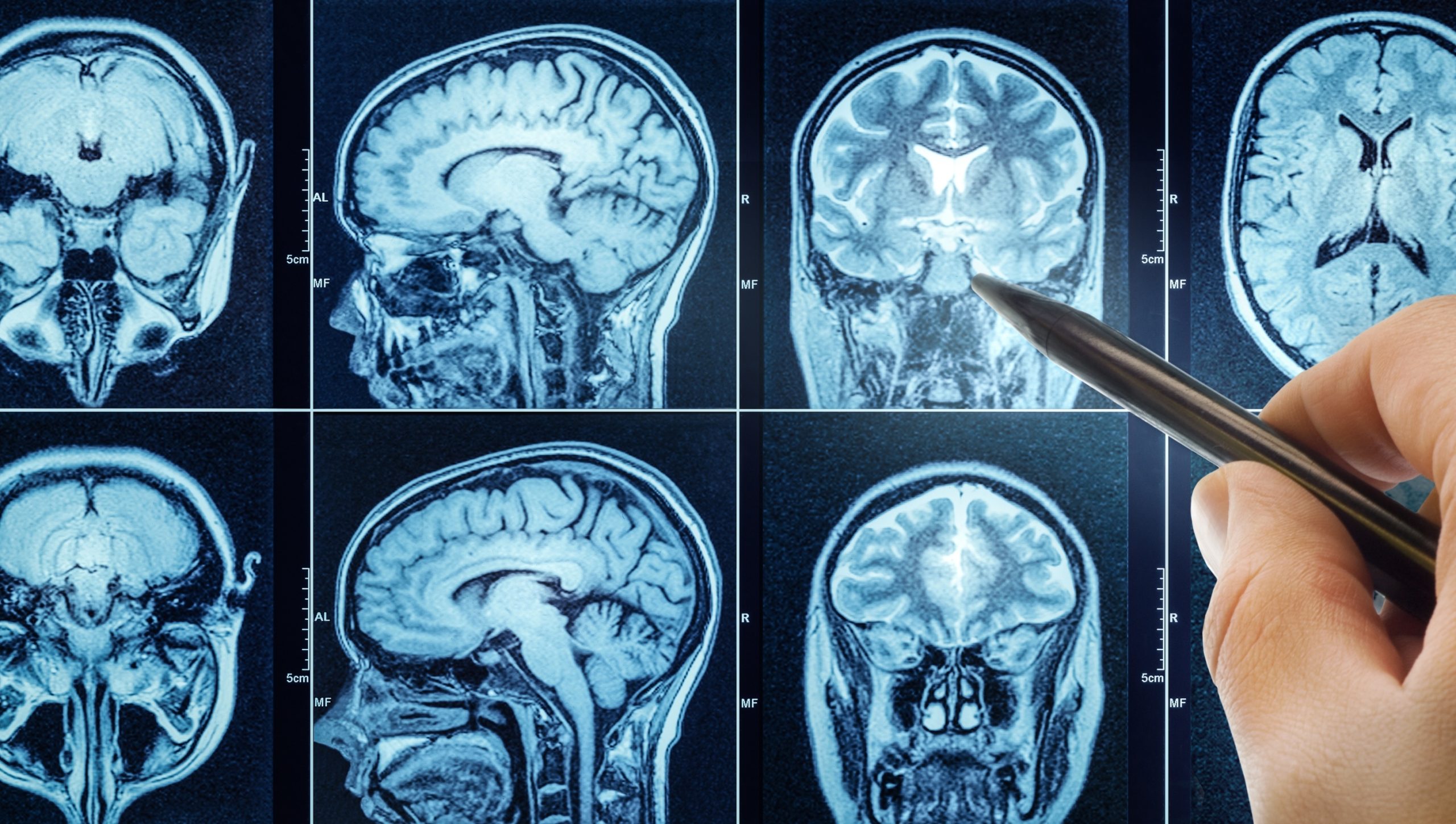 Expert Care for Ganglioglioma Brain Tumor in Los Angeles
