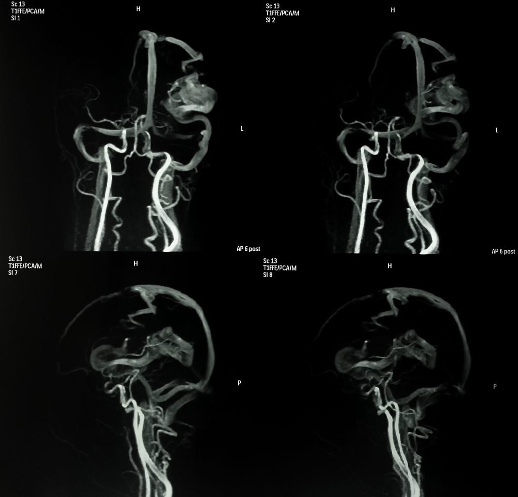 Expert Care for Arteriovenous Malformation in Los Angeles