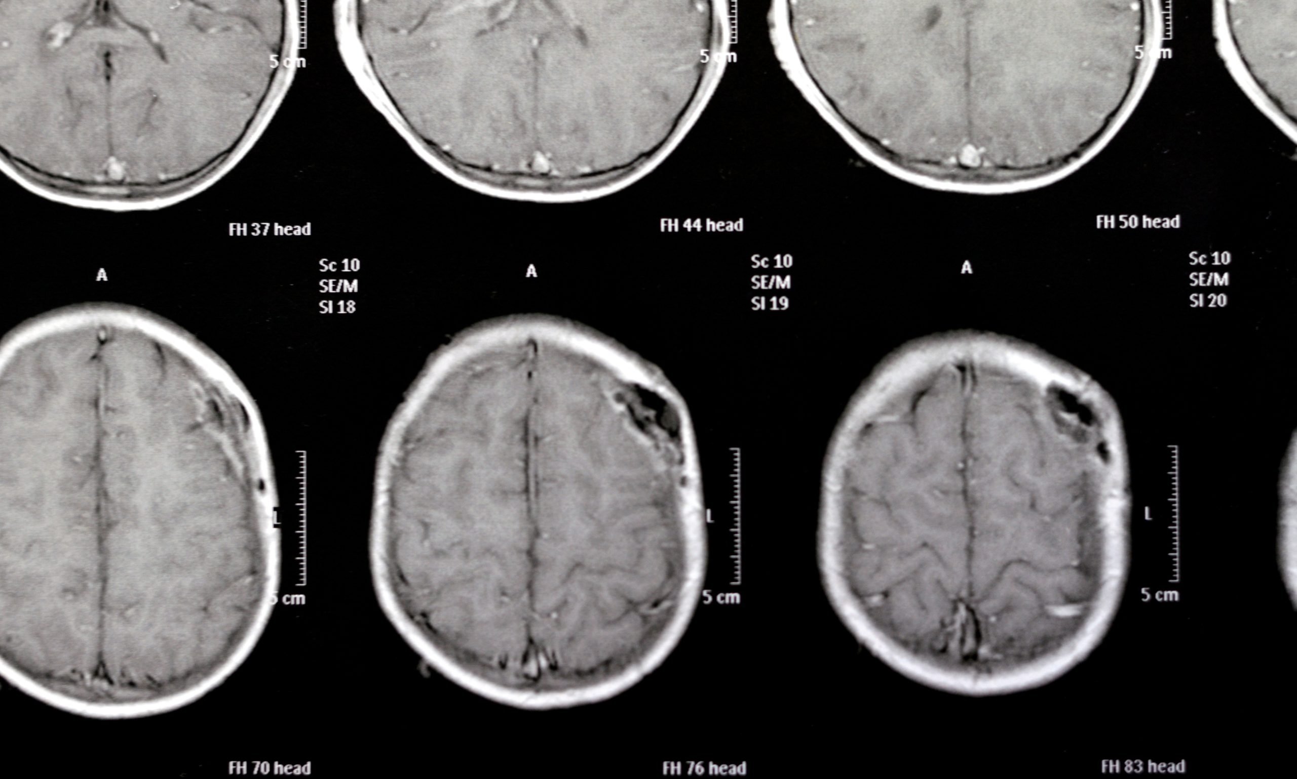 Expert Care for Normal Pressure Hydrocephalus in Los Angeles